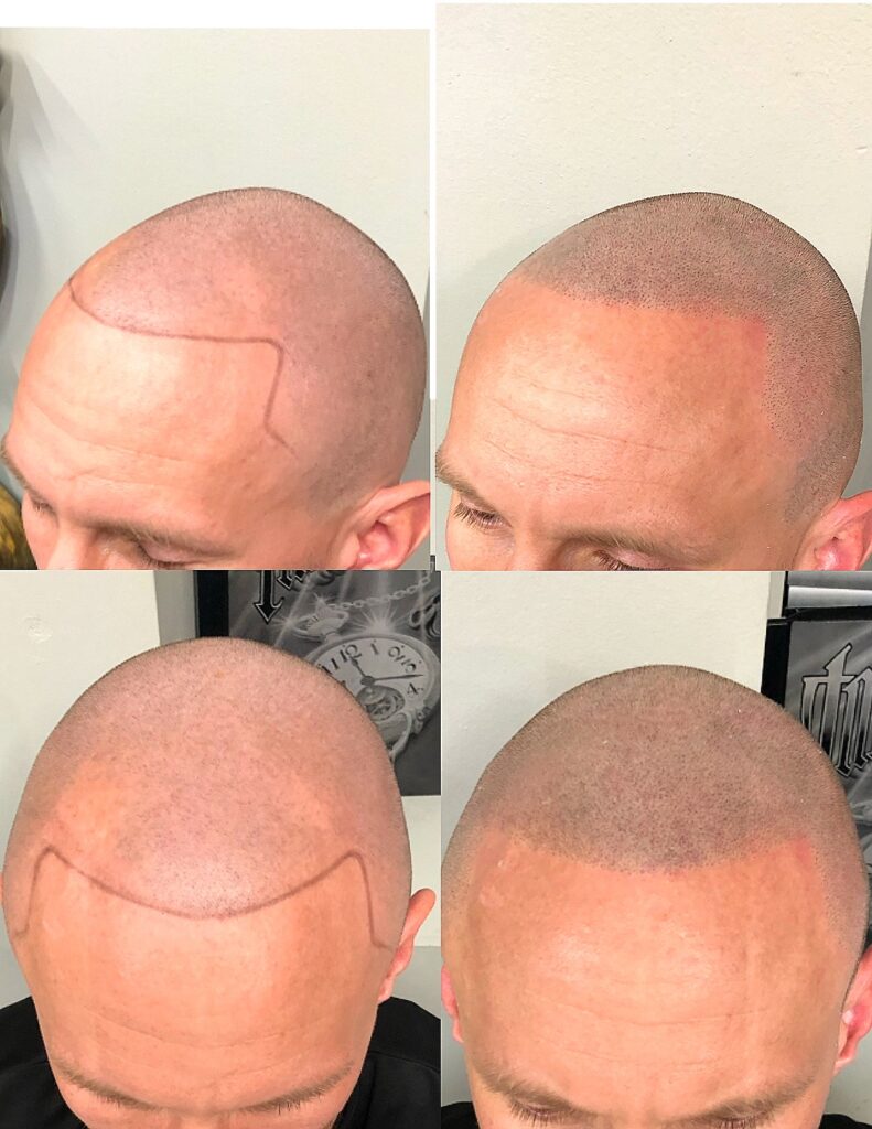 Before and After - Dallas Scalp Associates