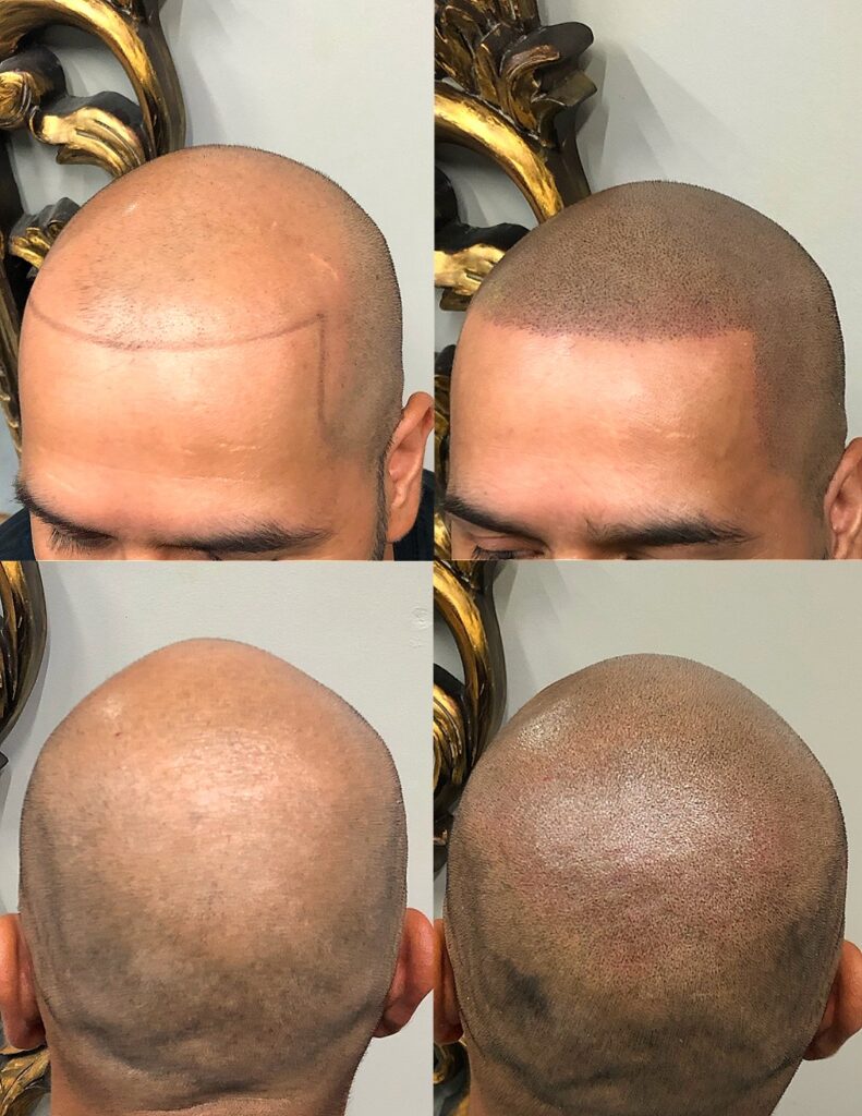 Before and After - Dallas Scalp Associates