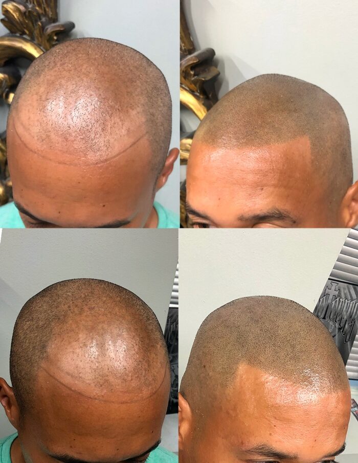 Before and After - Dallas Scalp Associates
