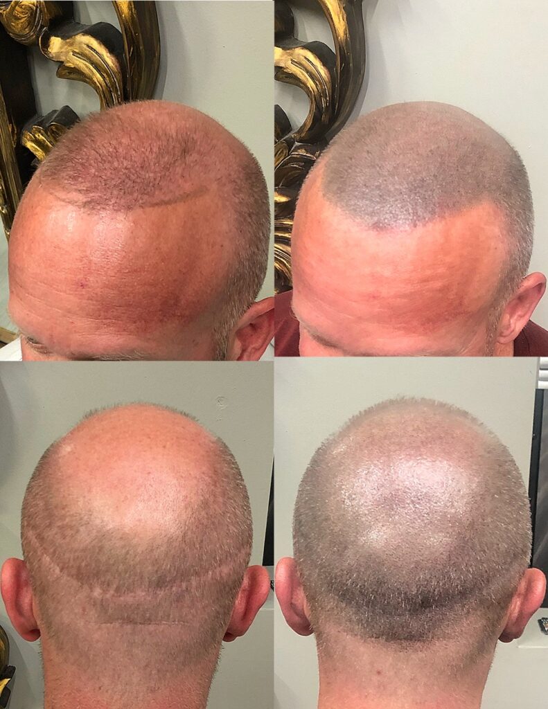 Before and After - Dallas Scalp Associates