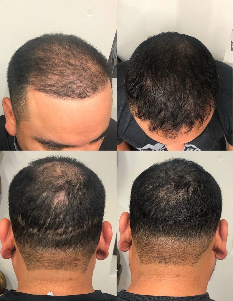 Before and After - Dallas Scalp Associates